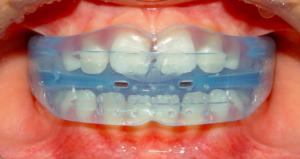 Oral Habit-Breaking Appliances for Children's Dental Health