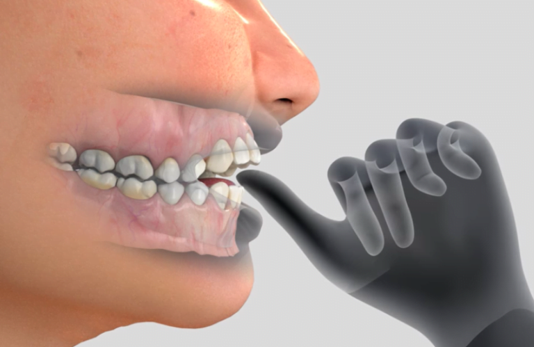 Oral Habit-Breaking Appliances for Children's Dental Health